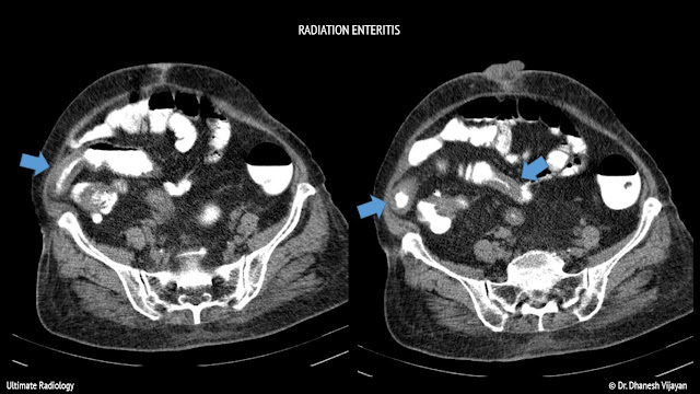 Ultimate Radiology : Radiation enteritis