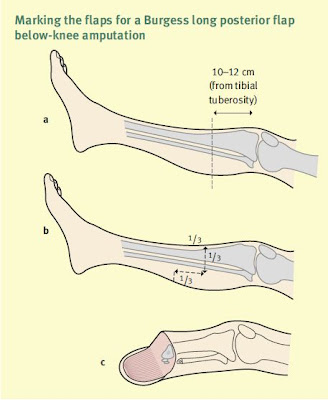 My Medical Notes: The Burgess Long Posterior Flap Below Knee Amputation