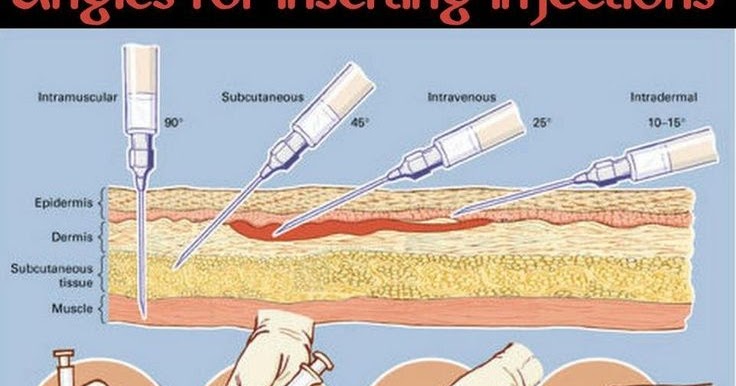 Medical and Health Science: Angles for inserting injections