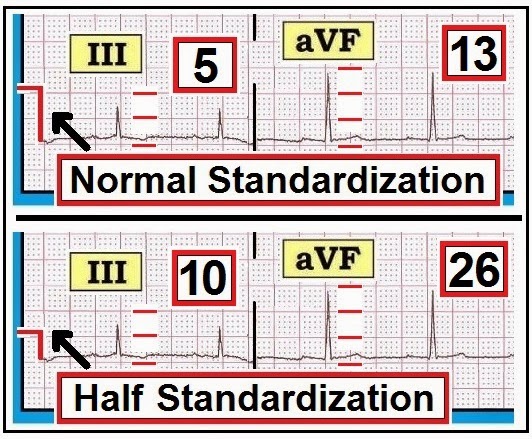 ECG Interpretation: ECG Blog #92 (Basic Concepts-5) – LVH