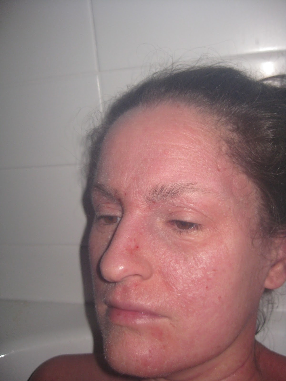 Topical Steroid Withdrawal Journey-Healing Eczema and Red Skin Syndrome ...