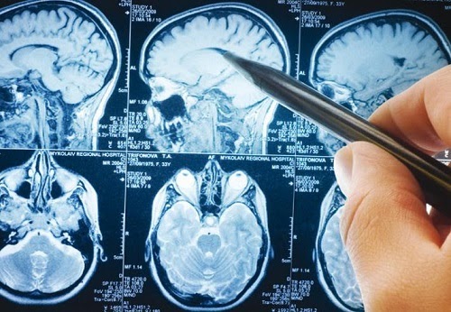 Brain Disease: Growing Cases of Brain-related Diseases and Disorders ...