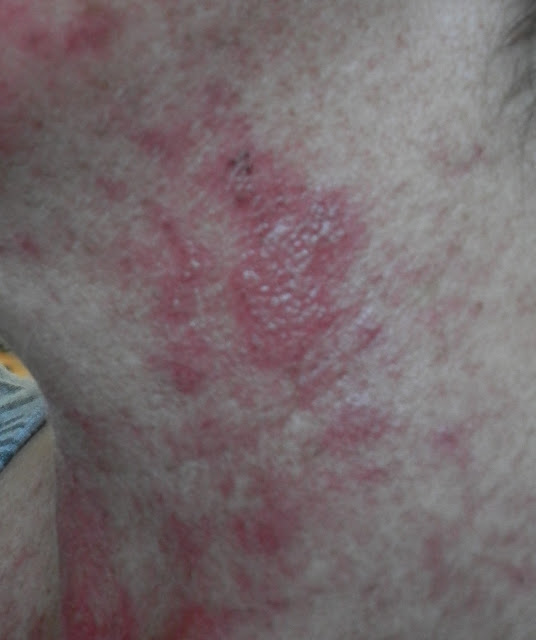 Efudex and Me 2013: Efudex Day Seventeen