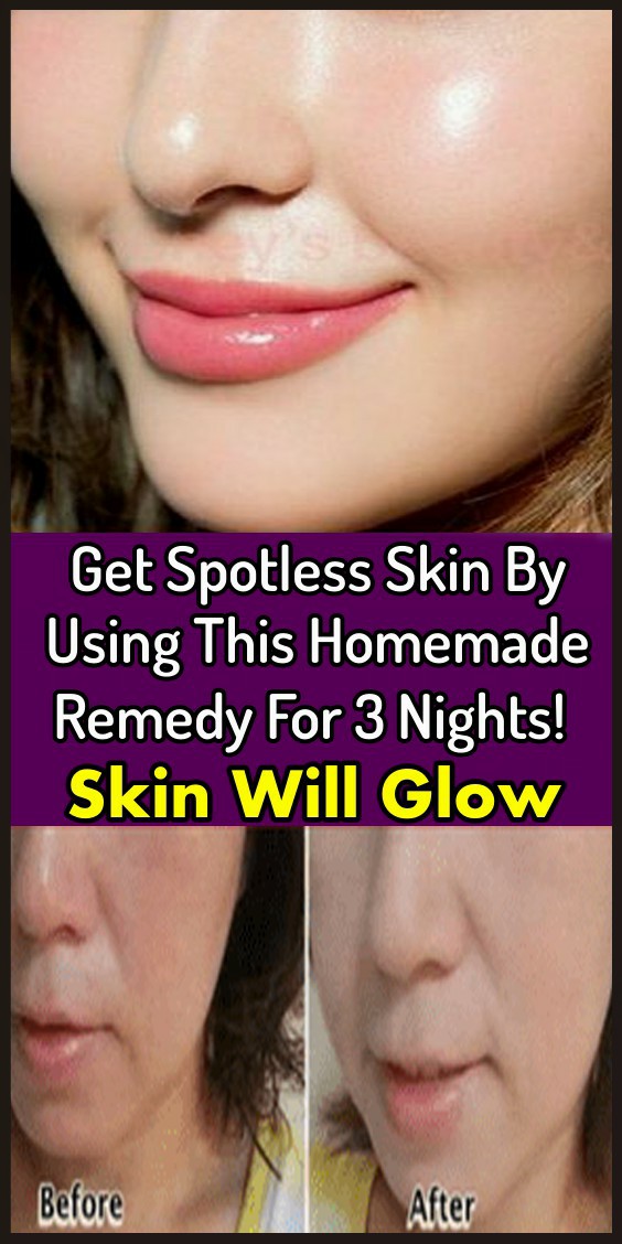 Get Spotless Skin By Using This Homemade Remedy For 3 Nights! Your Skin ...