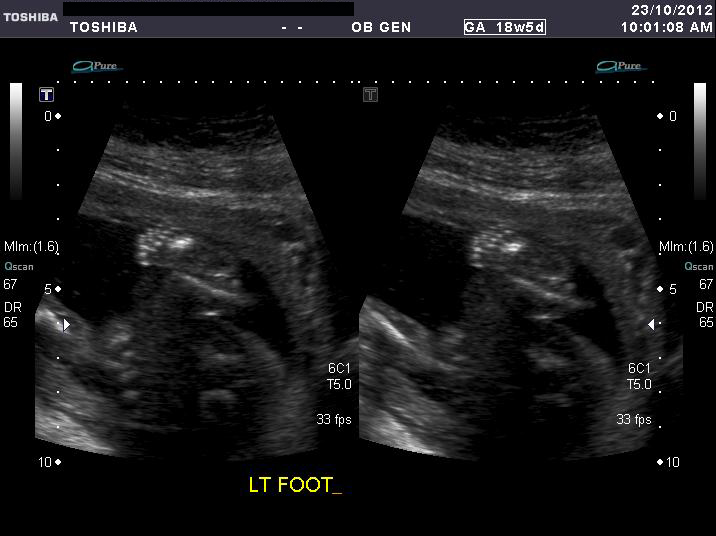 Someday, She Said: 19 Weeks & Anatomy Scan