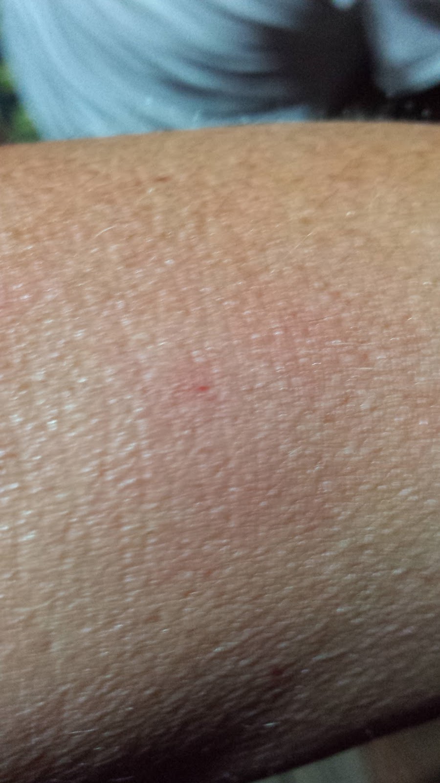 Articles That Teach Us How To Heal Ourselves: Apis for Healing Bites ...