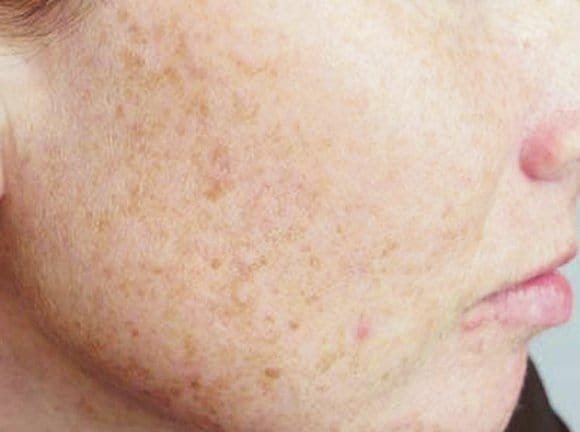 Types Of Skin Pigmentation - beautyandhealth
