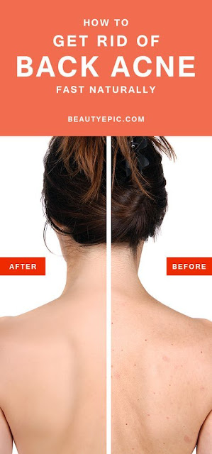 How To Get Rid of Back Acne Fast Naturally - TOP 5 DIY