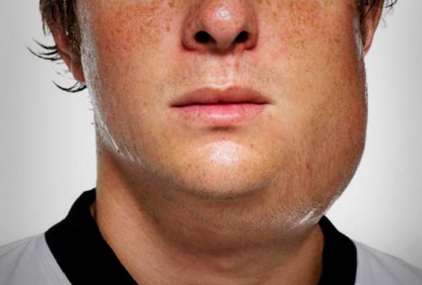 Bahaya Penyakit Beguk (mumps), Siptom dan Cara Merawat Beguk | Petua ...