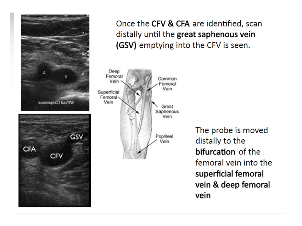 BÀI SOẠN VỀ SIÊU ÂM CHẨN ĐOÁN: Acute and Chronic DVT and Ultrasound (US)