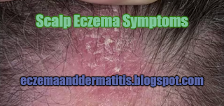 Scalp Eczema Symptoms - Eczema and Dermatitis