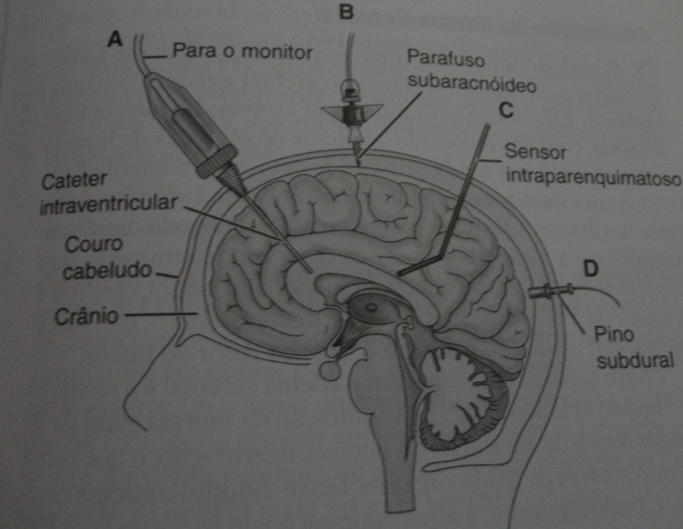 Rio Enfermagem: Pressão Intracraniana