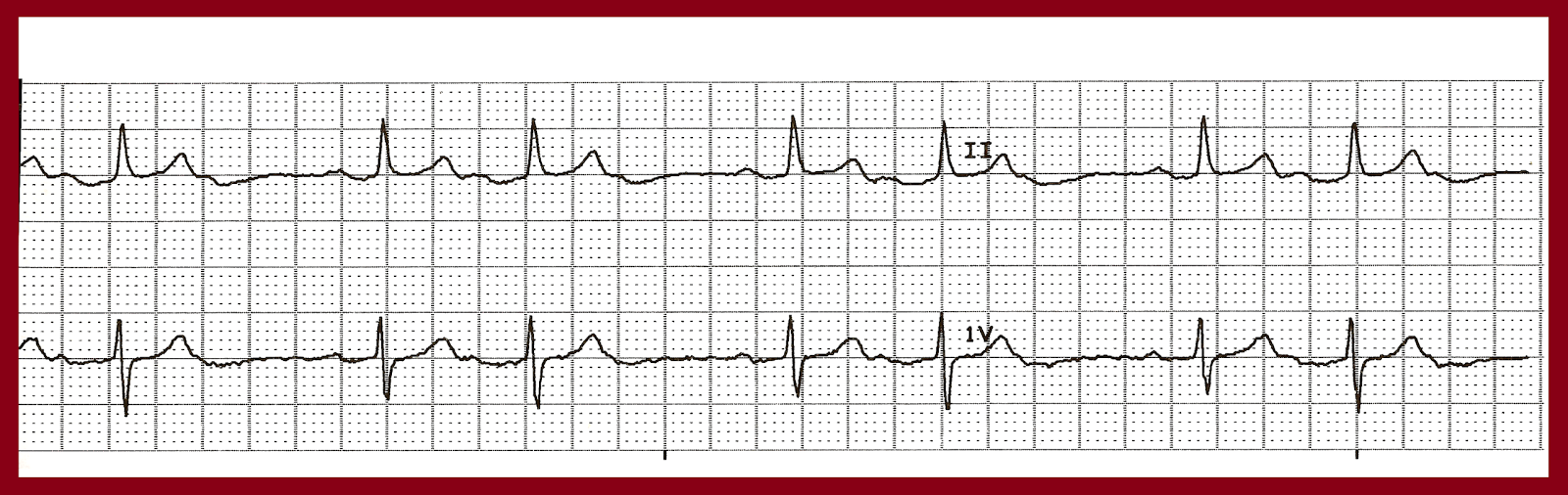 Practice EKG Strips 219
