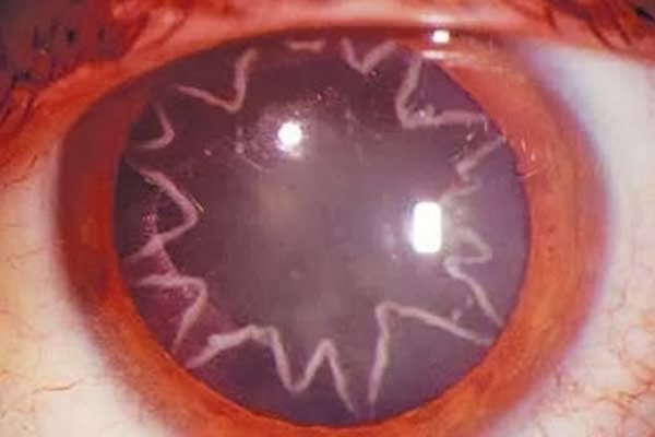 Amazing: California electrician has star shaped cataracts in his eyes ...