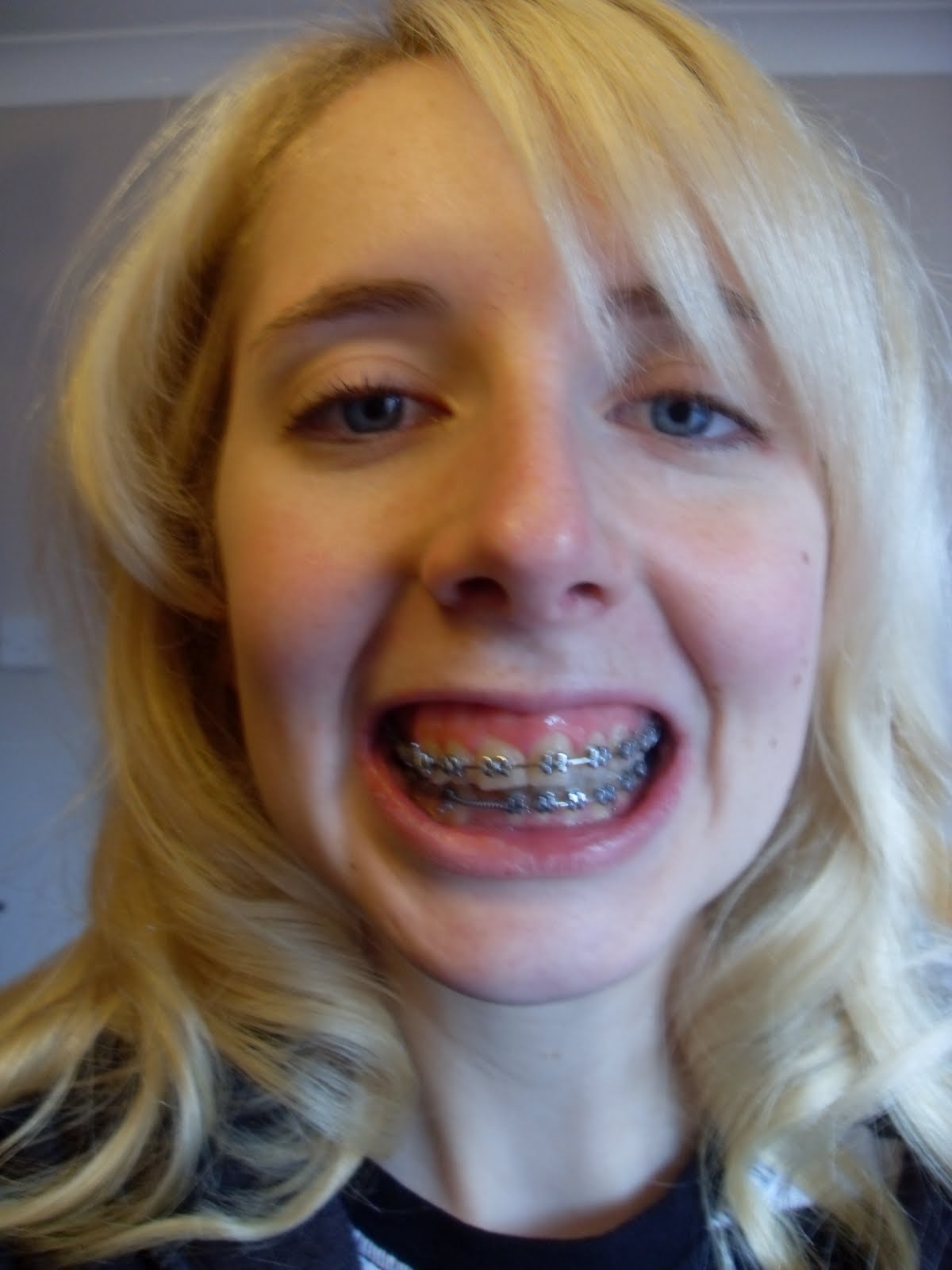 My Jaw Surgery Story: 6 months of braces and appointment update