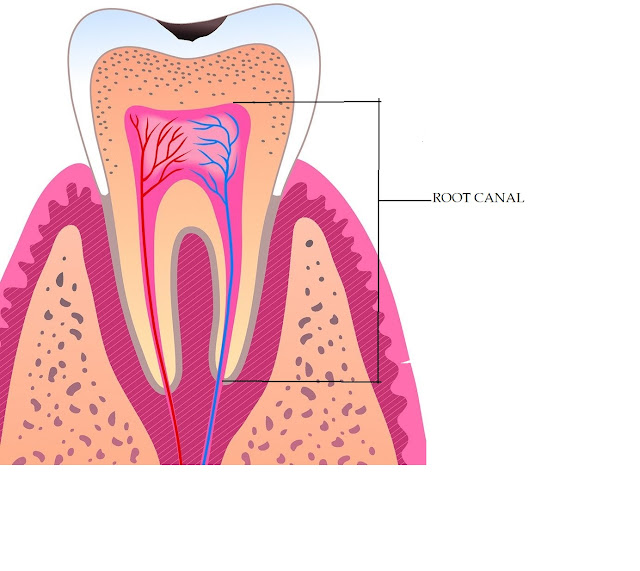WHAT, WHEN, HOW AND WHYS OF ROOT CANAL TREATMENT