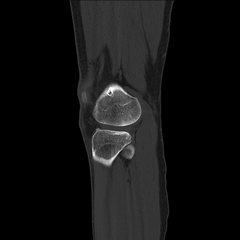 CT Knee - Radiology Imaging