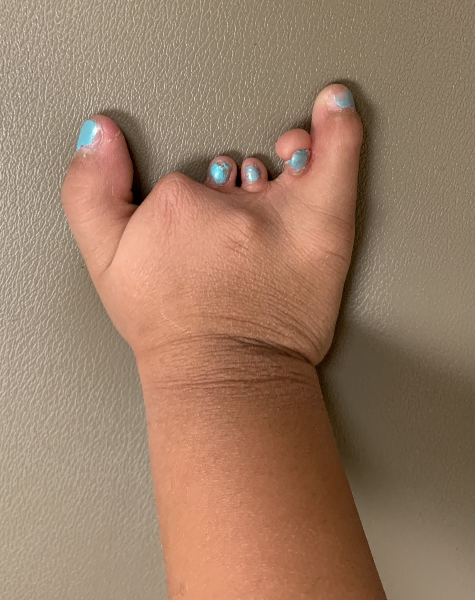 Congenital Hand and Arm Differences