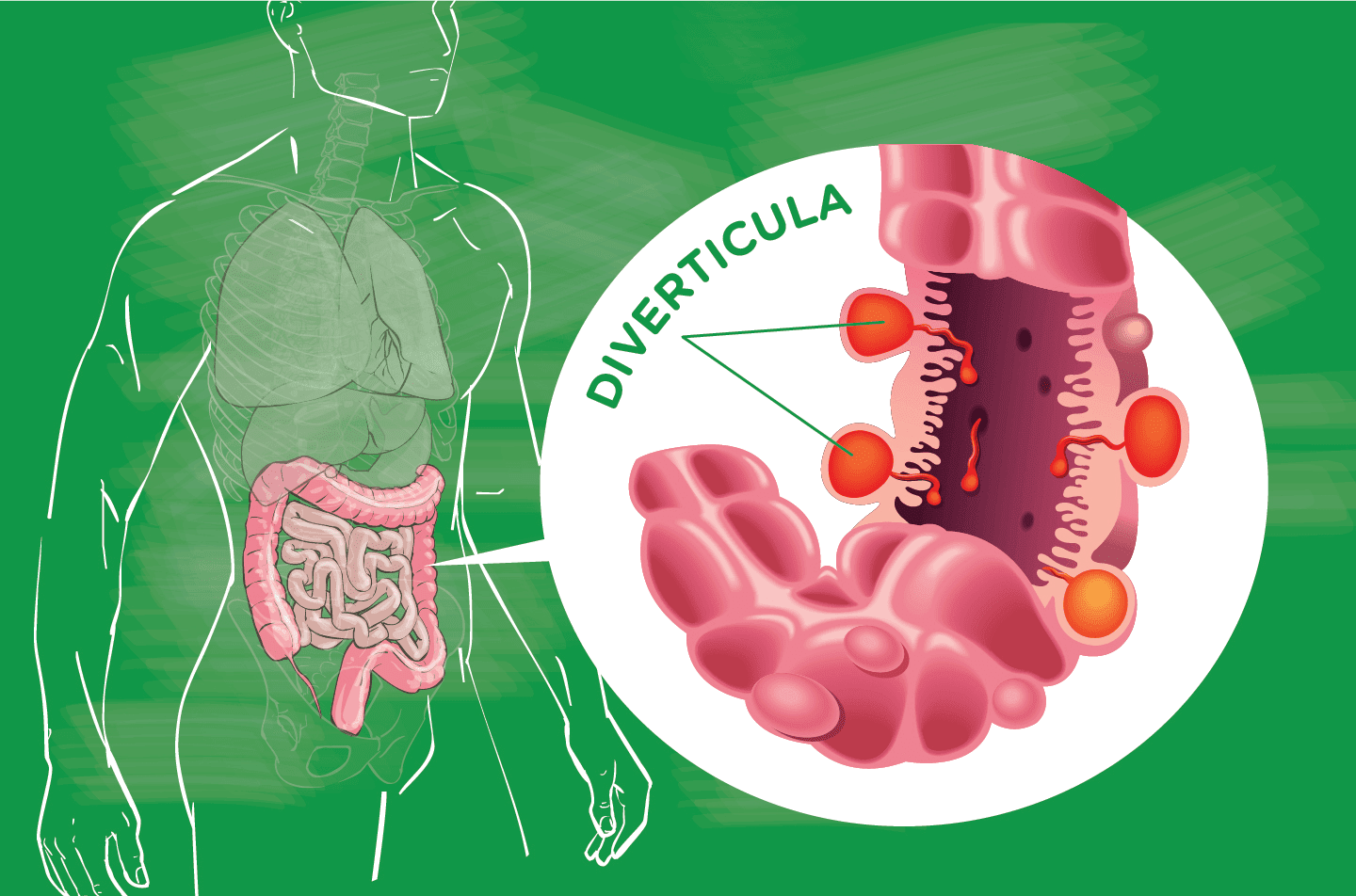 What is Diverticulitis? - What No One Tells You About Diverticulitis