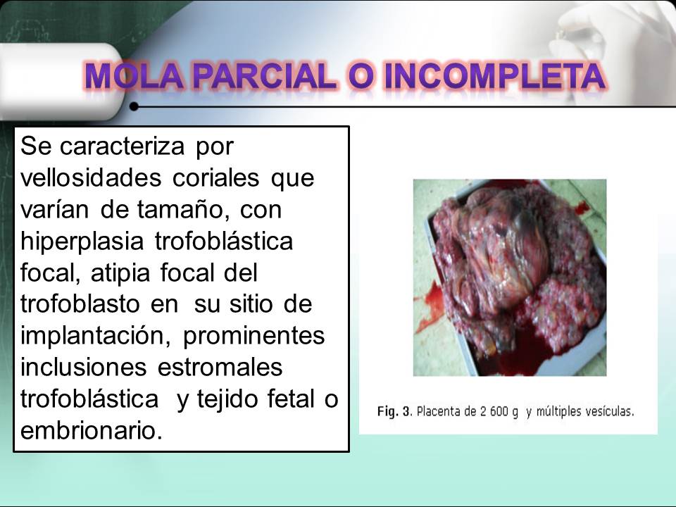 embarazo molar