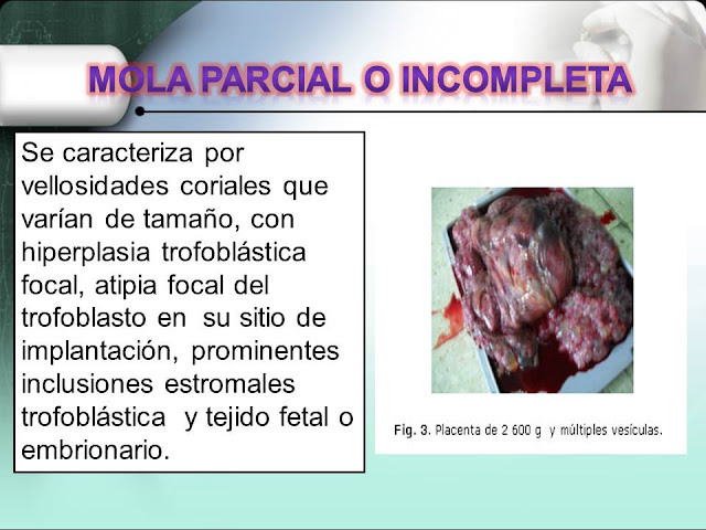 embarazo molar