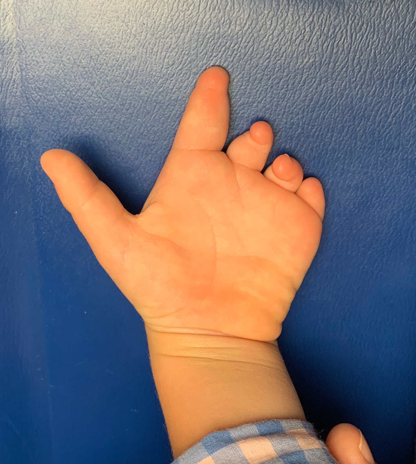 Only a thumb. Amazing outcome! | Congenital Hand and Arm Differences ...