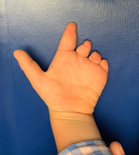Only a thumb. Amazing outcome! | Congenital Hand and Arm Differences ...