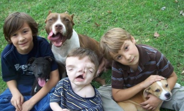 Photos: Tres Johnson Baby Boy Born With Two Faces Defies Medical Odds ...