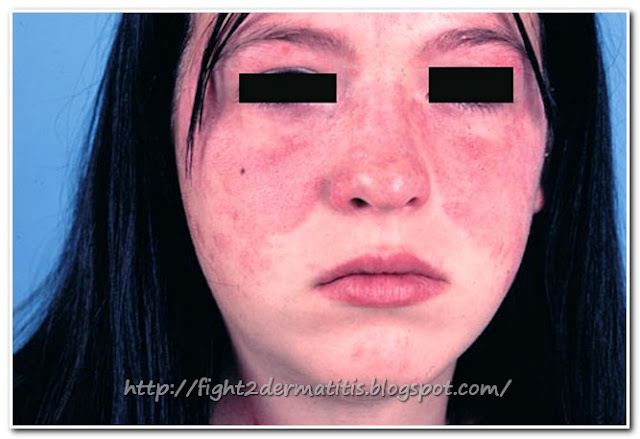 A Startling Fact about Dermatitis Lupus Uncovered Dermatitis Lupus - Is ...