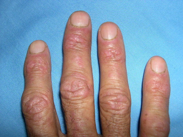 Miositis inflamatoria idiopática: Revisión sobre sus diagnósticos ...