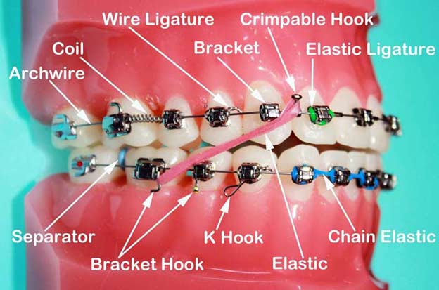 Free Online Dental Consultation: Dental Braces