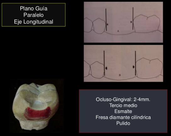 Prótesis Parcial Removible (PPR)