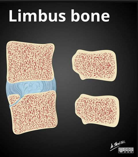 Limbus vertebrae | CĐHA | CHẨN ĐOÁN HÌNH ẢNH
