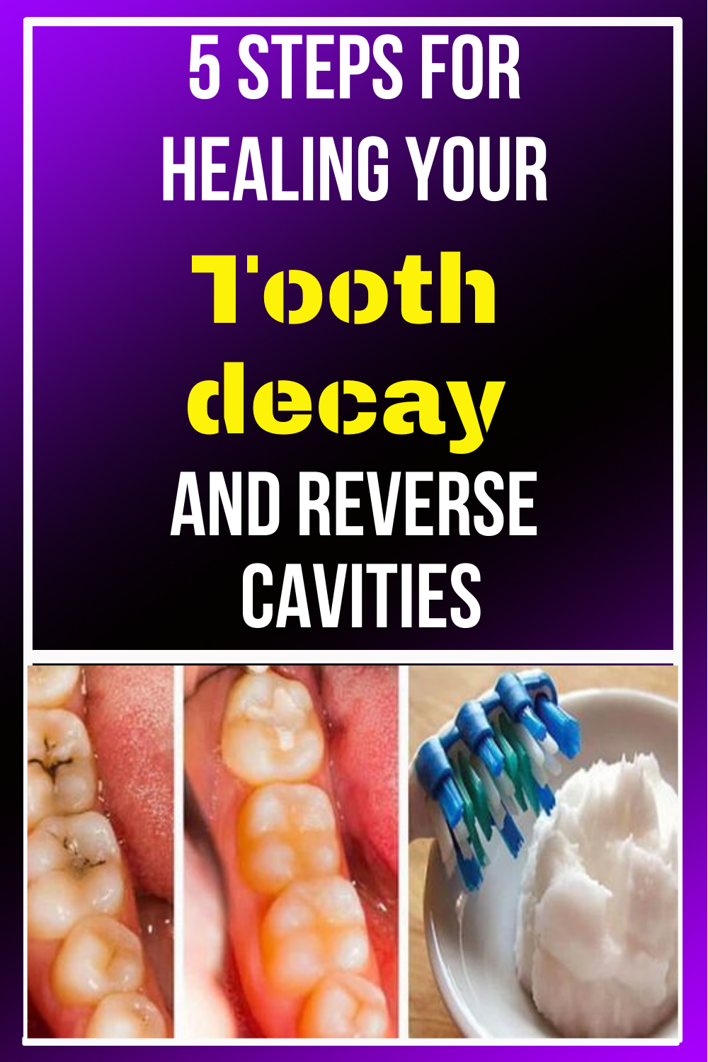 5 Steps For Healing Your Tooth decay And Reverse Cavities