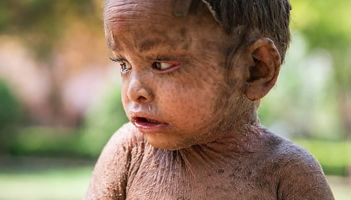2 year old Indian Girl Suffers From Rare Skin Condition Causing Her To Develop Reptile like 2-year-old-indian-girl-suffers-from-rare-skin-condition-causing-her-to-develop-reptile-like