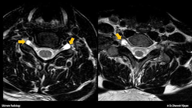 Ultimate Radiology : Perineural cysts (Tarlov cysts) of the cervical spine