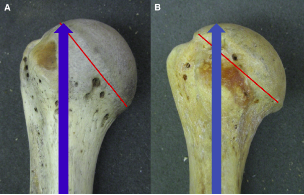 UW Shoulder and Elbow Academy: Humeral arthroplasty - does the entry ...