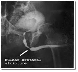 NURHOLIS MEDICAL ARTICLE: STRIKTUR URETRA