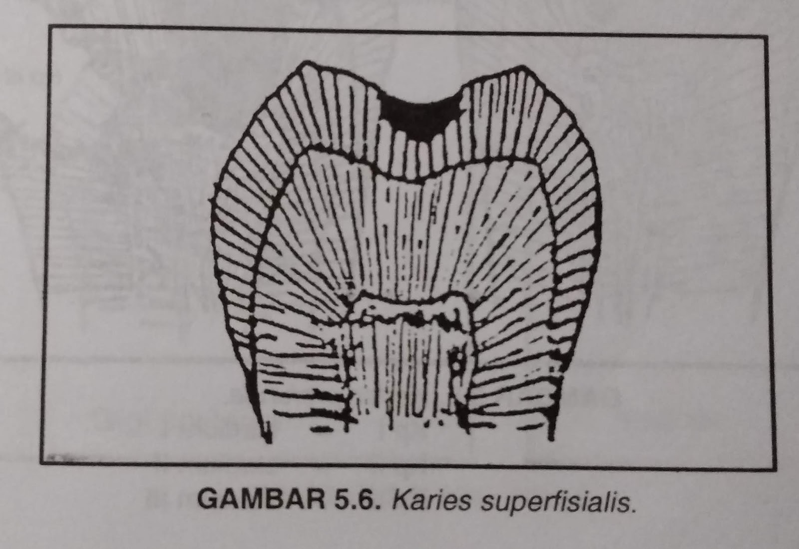 Karies Gigi Berdasarkan Stadium Karies dan Cara Meluasnya