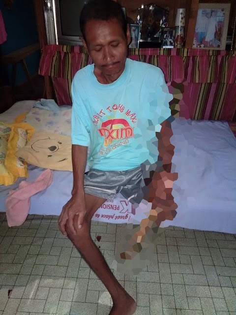 VIRAL: Lalaking may kakaibang cancer sa buto, humihingi ng tulong