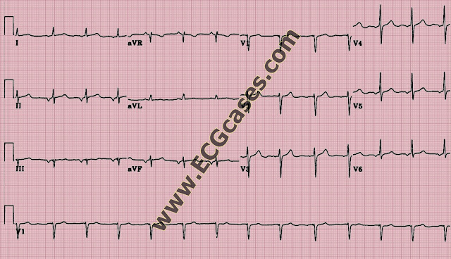 gw manis: Retrograde P Wave