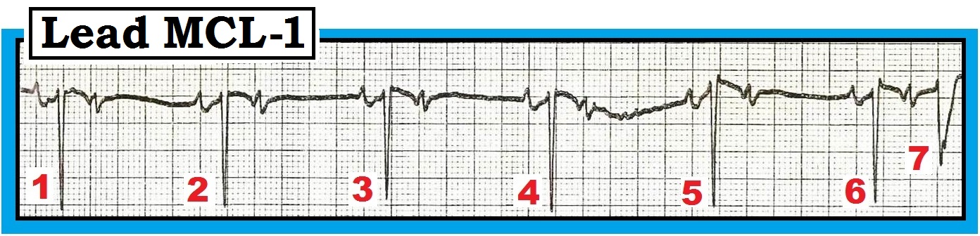 ECG Interpretation: ECG Interpretation Review #57 (Mobitz I - Mobitz II ...