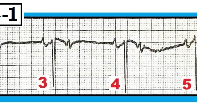 ECG Interpretation: ECG Interpretation Review #57 (Mobitz I - Mobitz II ...