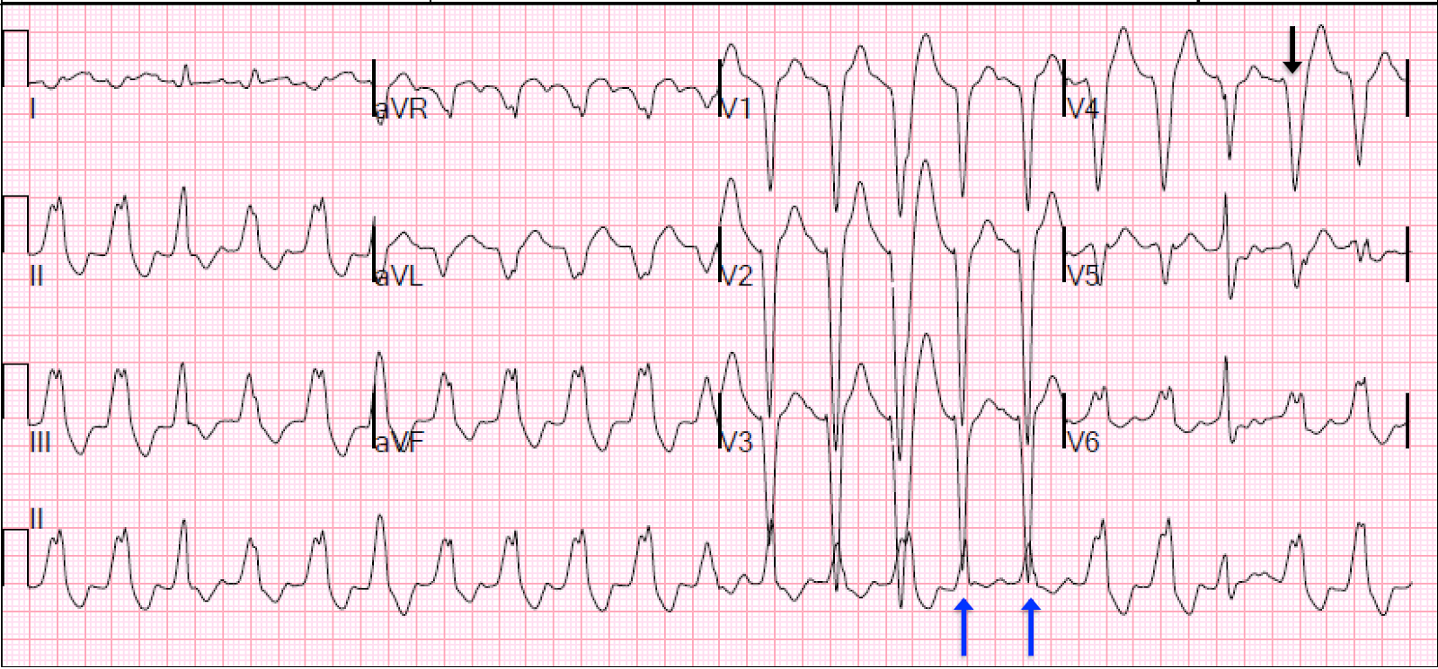 Dr. Smith's ECG Blog: Wide Complex Tachycardia Refractory to Anti ...