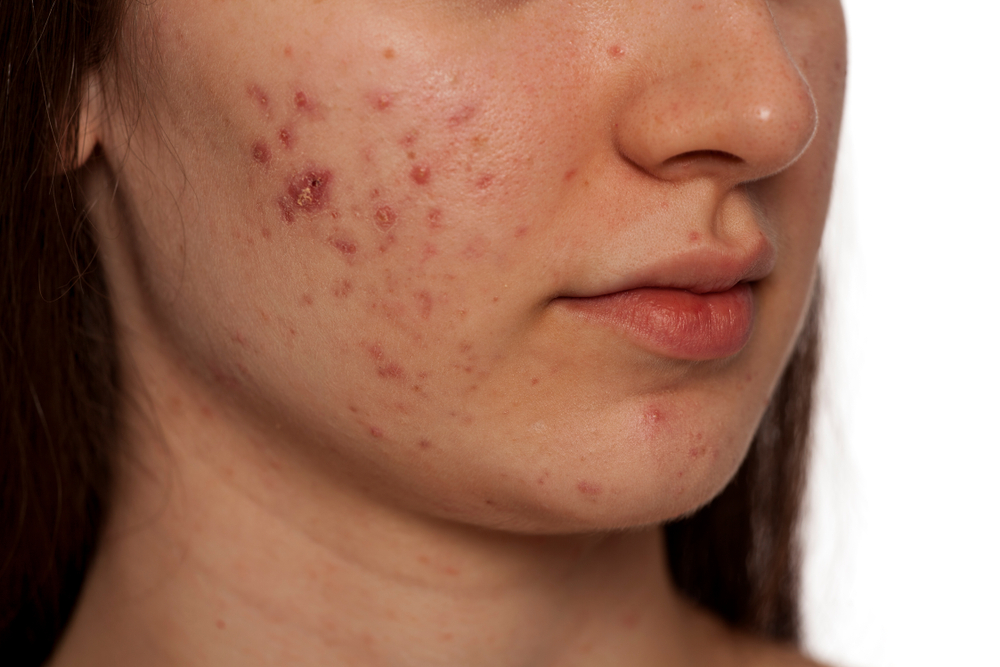 Remove Acne In A Week With The Use Of This Simple And Most Trusted remove-acne-in-a-week-with-the-use-of-this-simple-and-most-trusted