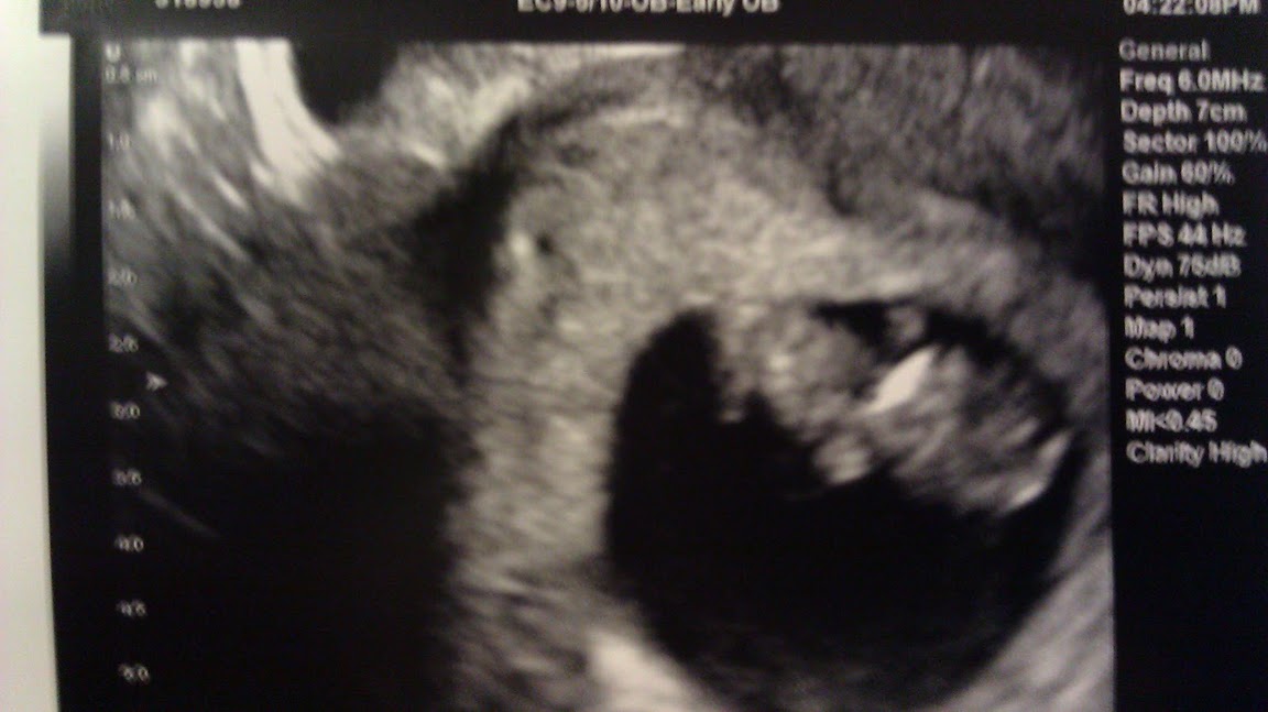 Our Baby Story: An Active Baby (9 week Update)