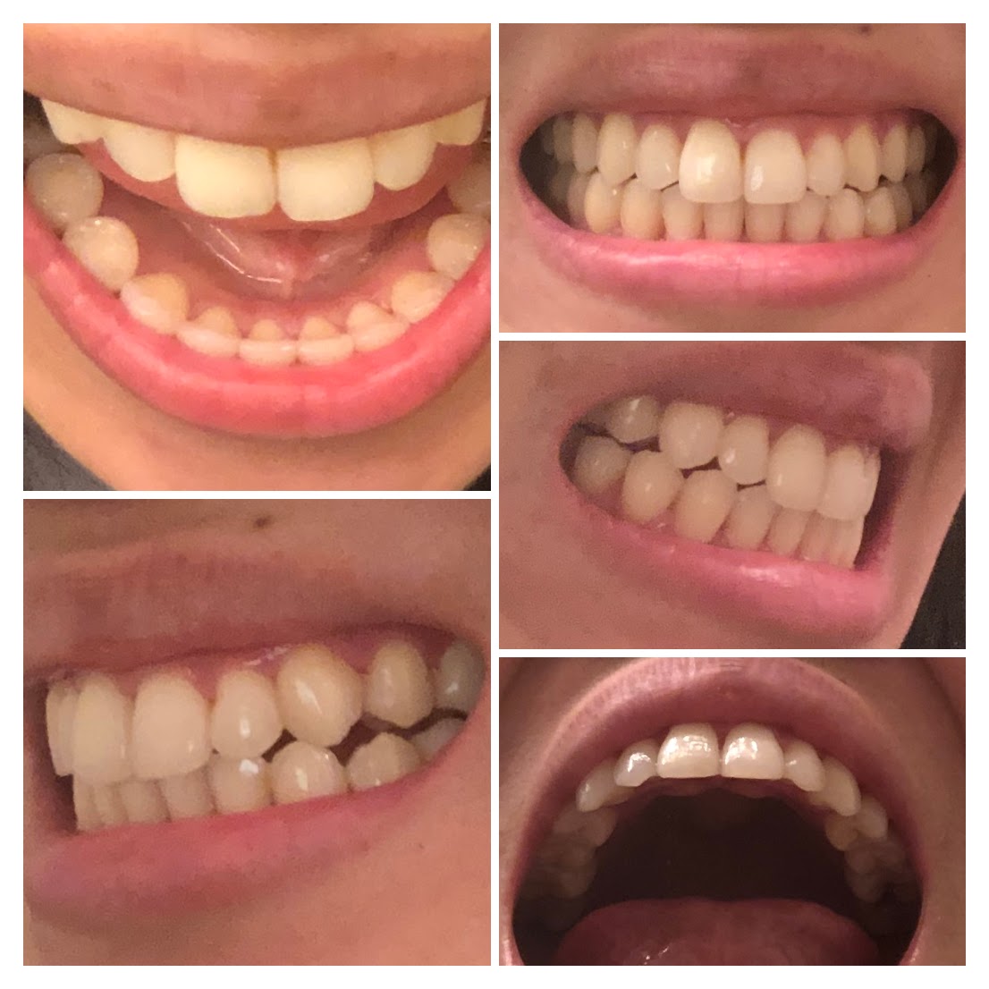 Tales of a formerly snaggle toothed bride to be and orthodontic relapse