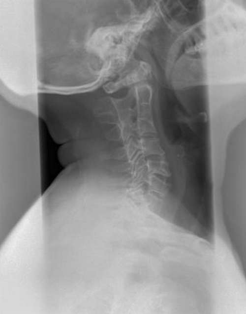 Klippel-Feil Syndrome Pictures | Medical Pictures and Images - (2023 ...