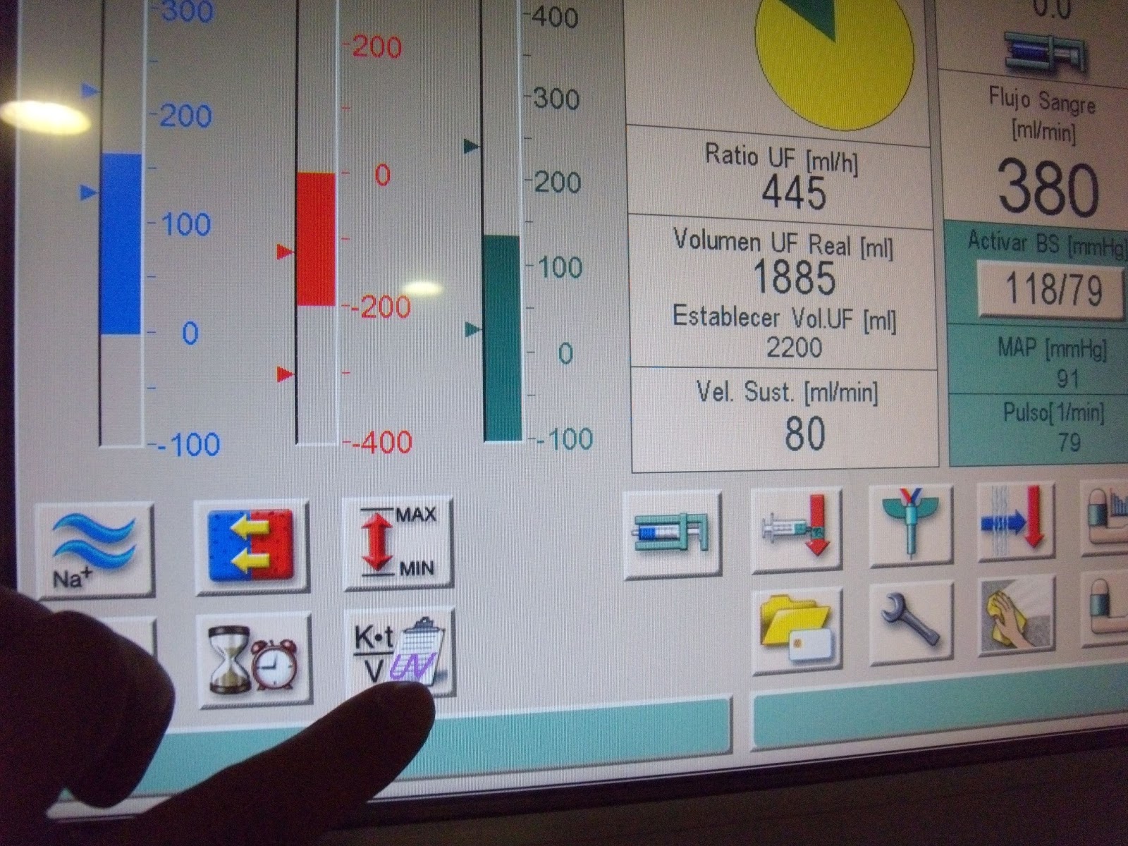 Diálisis, diario para principiantes: Hemodiálisis:Progamación resultado KT