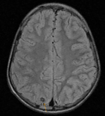 Post Ictal Edema-DWI - Sumer's Radiology Blog